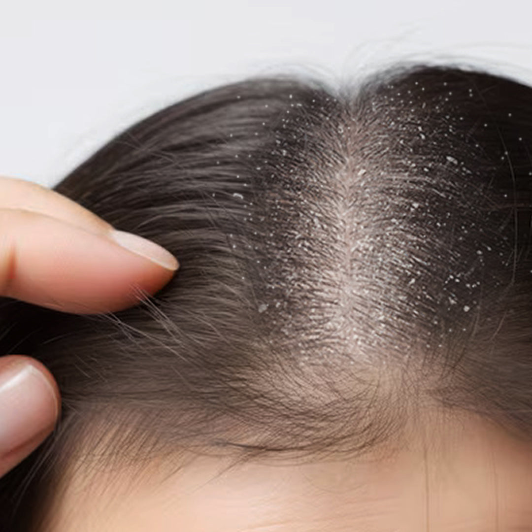 Dandruff Protection – PUREUS